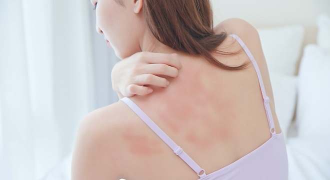 Síntomas De La Urticaria Qué Es Causas Y Tratamiento De La Enfermedad